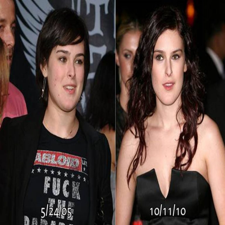 Searching for Perfection: Rumer Willis Before and After Plastic Surgery ...